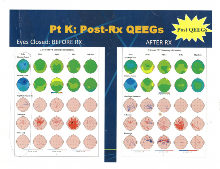 FASD | Neurofeedback & Integrated Therapy Institute