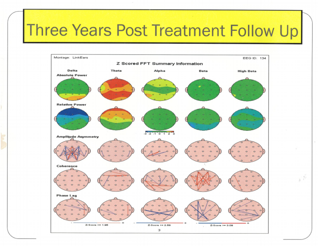 QEEG Analysis / Brain Mapping | Neurofeedback & Integrated Therapy ...